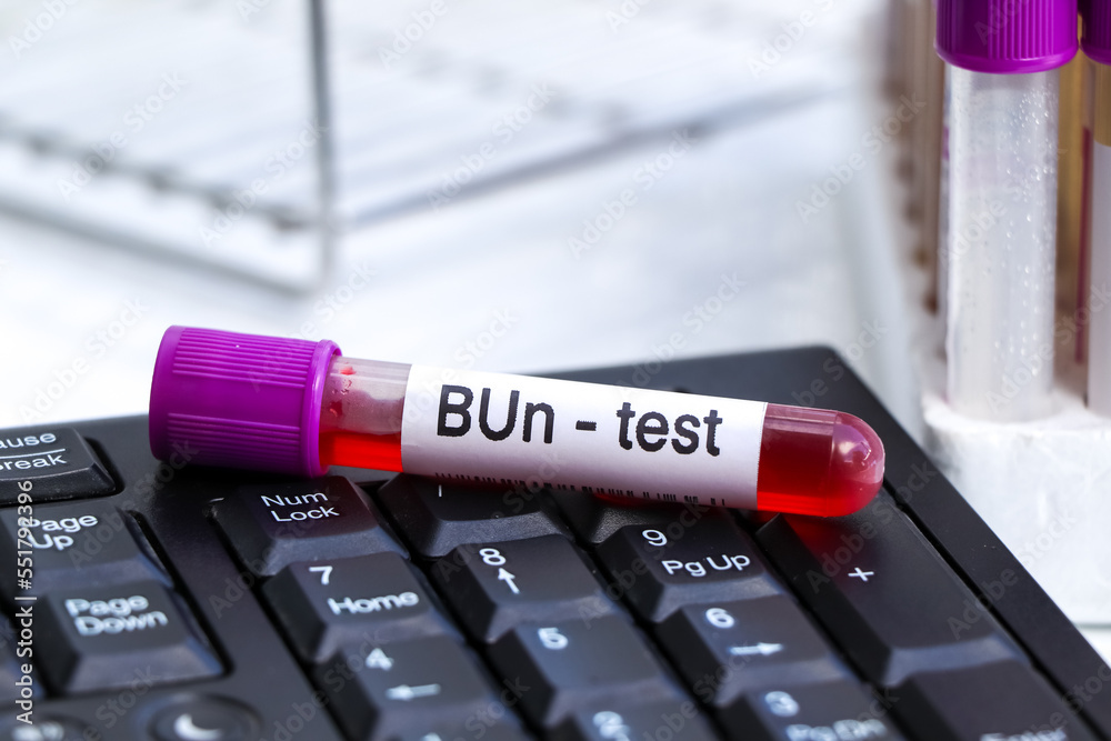 BUn test from blood , Blood samples to be analyzed in the laboratory ...