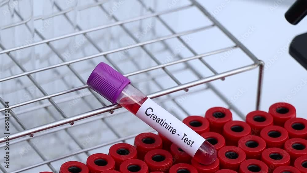 creatinine test to look for abnormalities from blood, blood sample to ...