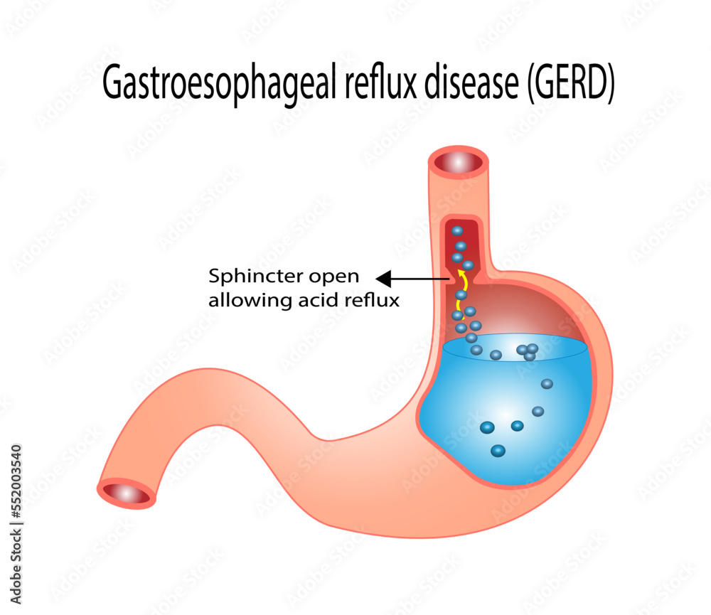 Poster Gastroesophageal Reflux Disease (GERD), Heartburn – Wall Art ...