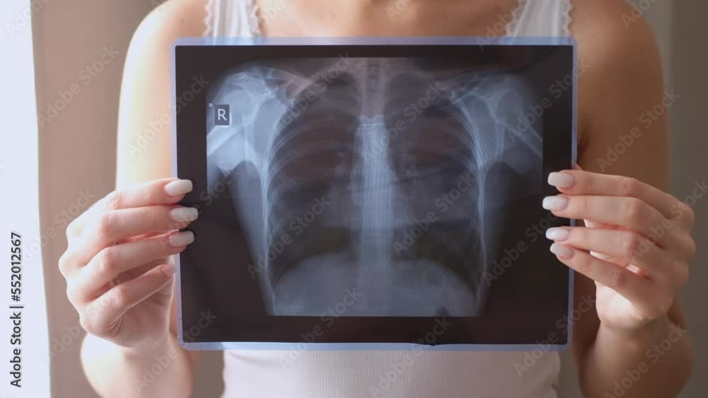 Lung radiography concept. Radiology doctor examining at chest x ray ...