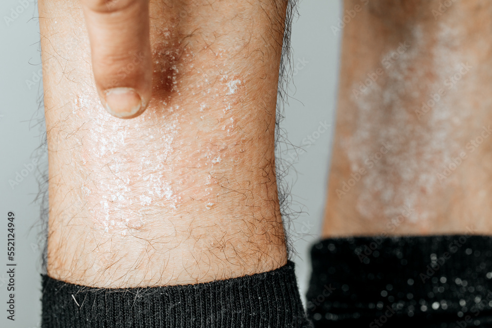 Acute psoriasis na is an autoimmune incurable dermatological skin ...