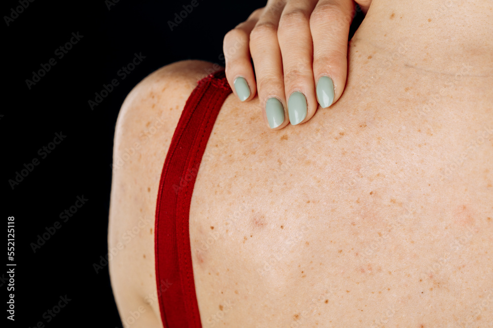 A young woman has pimples with red spots on her back, isolated on a ...