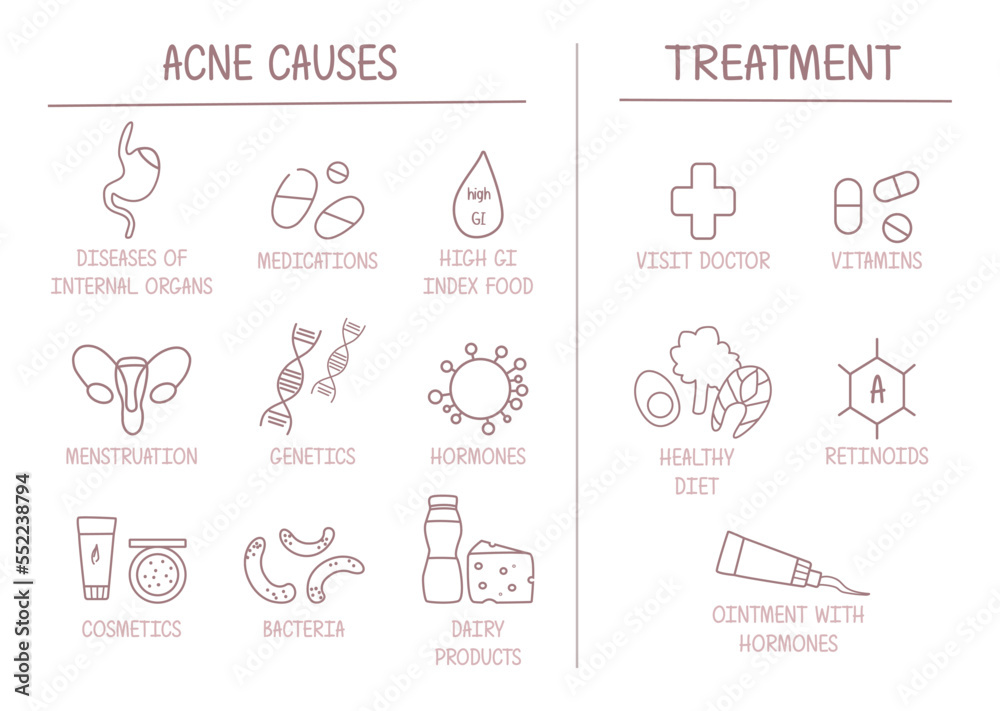 Acne causes and treatment. Infographics, instruction. Chemistry, skin ...