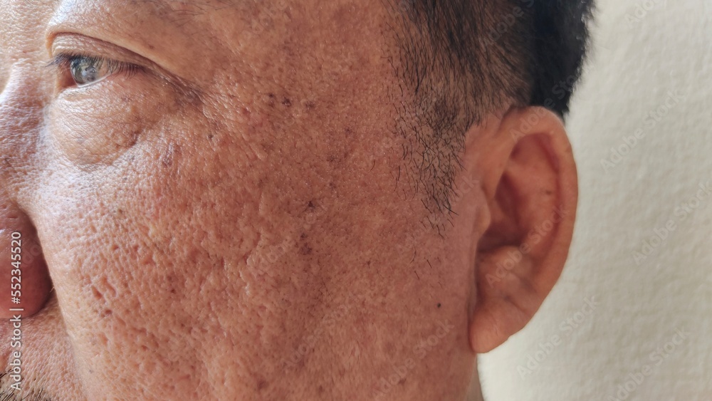 Foto de close up portrait the Freckles and blemish, blackhead and acne ...