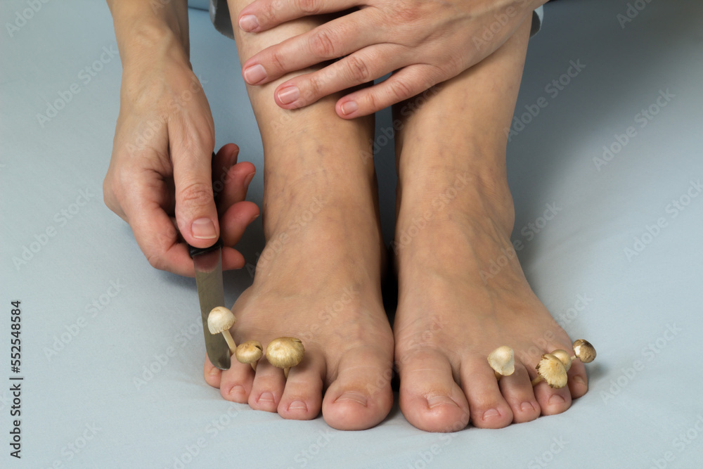 Close-up of female feet with fungus growing between toes. Woman's hand ...