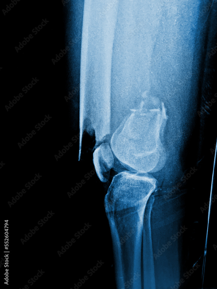 X-ray femur show complete fracture Stock Photo | Adobe Stock