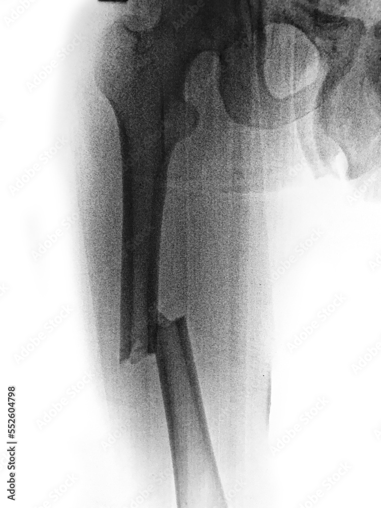 X-ray femur show complete fracture shaft of femur Stock Photo | Adobe Stock