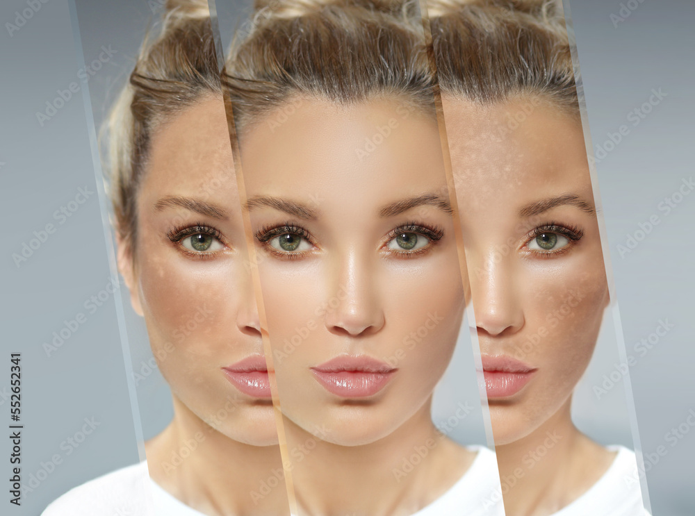 Dark spots, freckles,hyperpigmentation(melasma or chloasma),concept ...