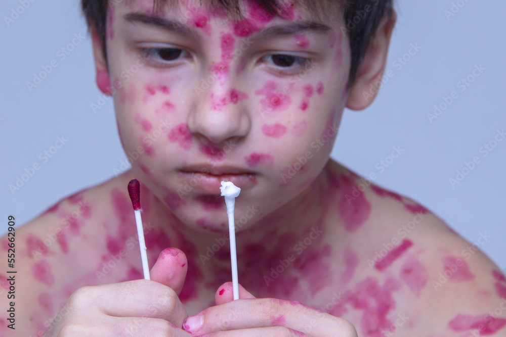 The skin rash in a child is treated with a cotton swab. Chickenpox ...