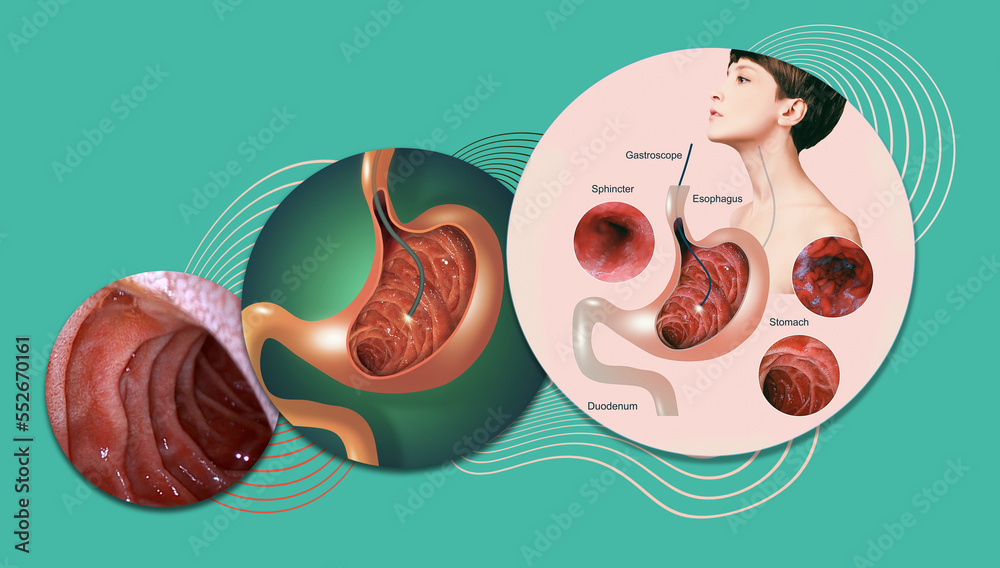 Poster Digestive endoscopy or gastroscopy – Wall Art | UkPosters