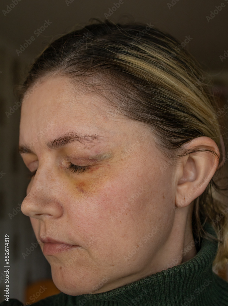 Double Eyelid Surgery, Eyes Surgery Recover Period, immediately after ...