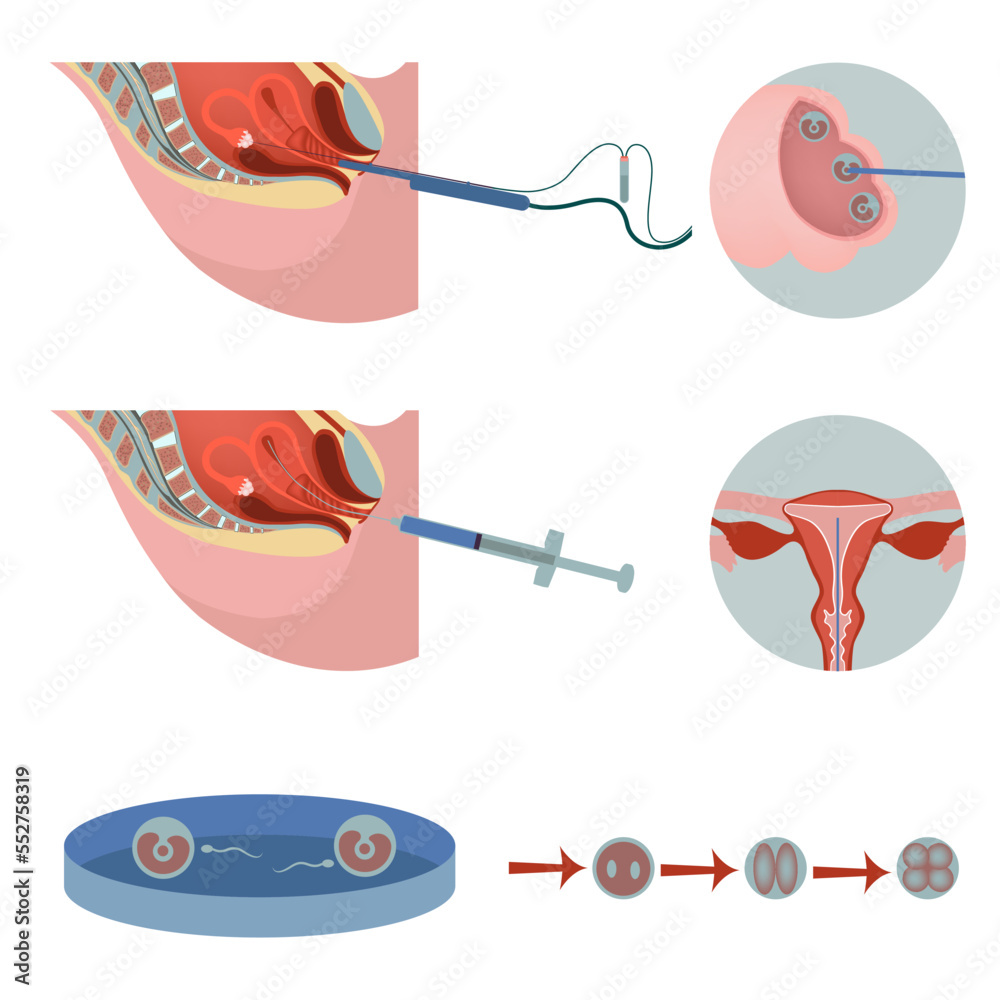 Artificial Insemination Woman Reproductive Organs Infographic And