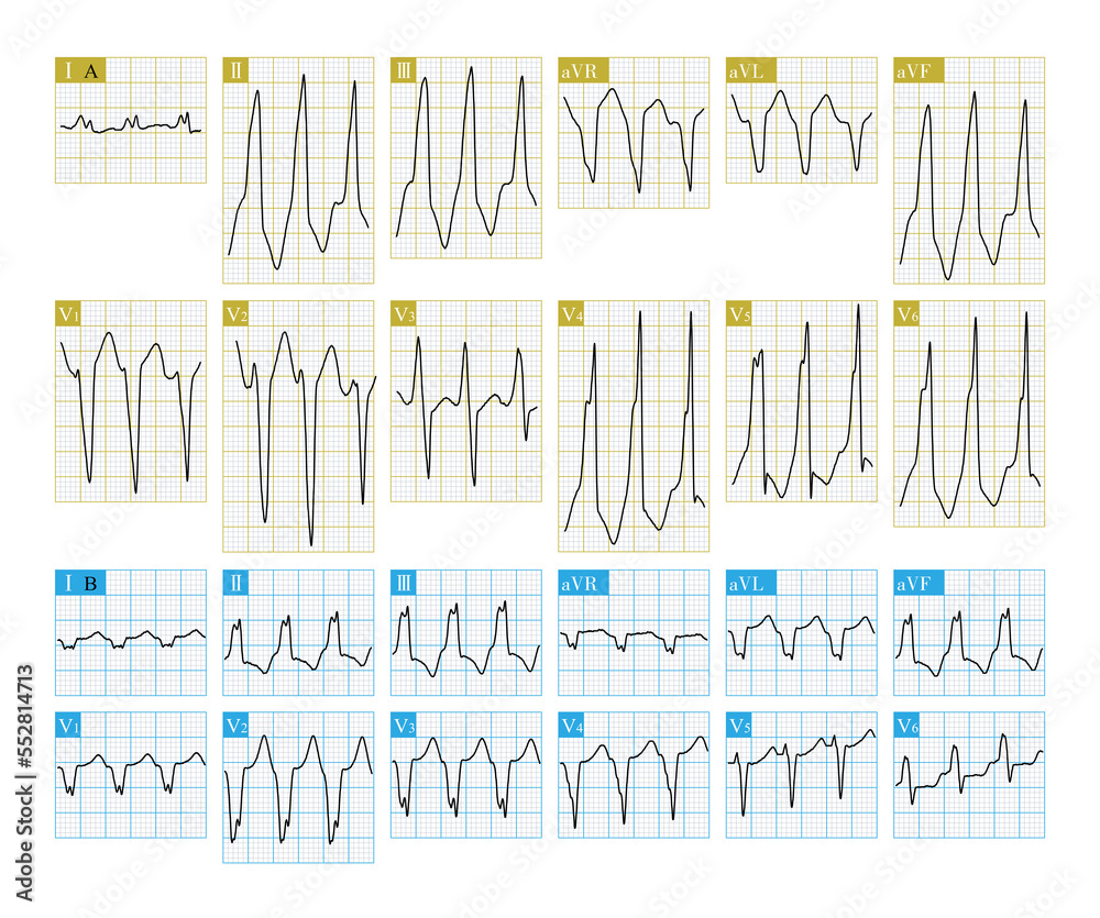 Poster A is idiopathic right ventricular outflow tract ventricular ...