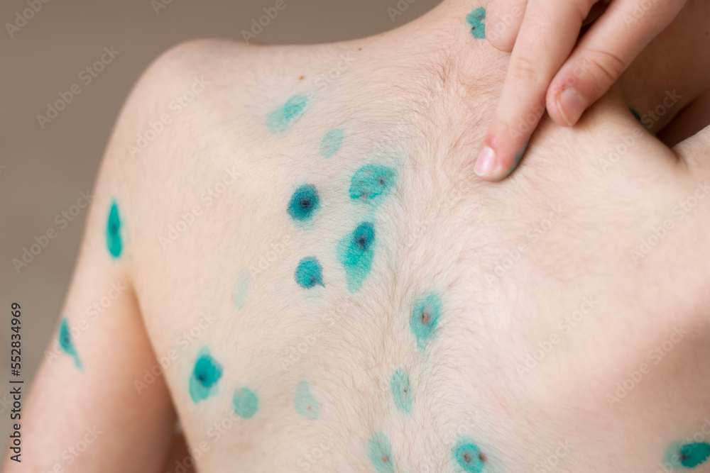 Child boy sick with chicken pox shows the bumps on his belly smeared ...