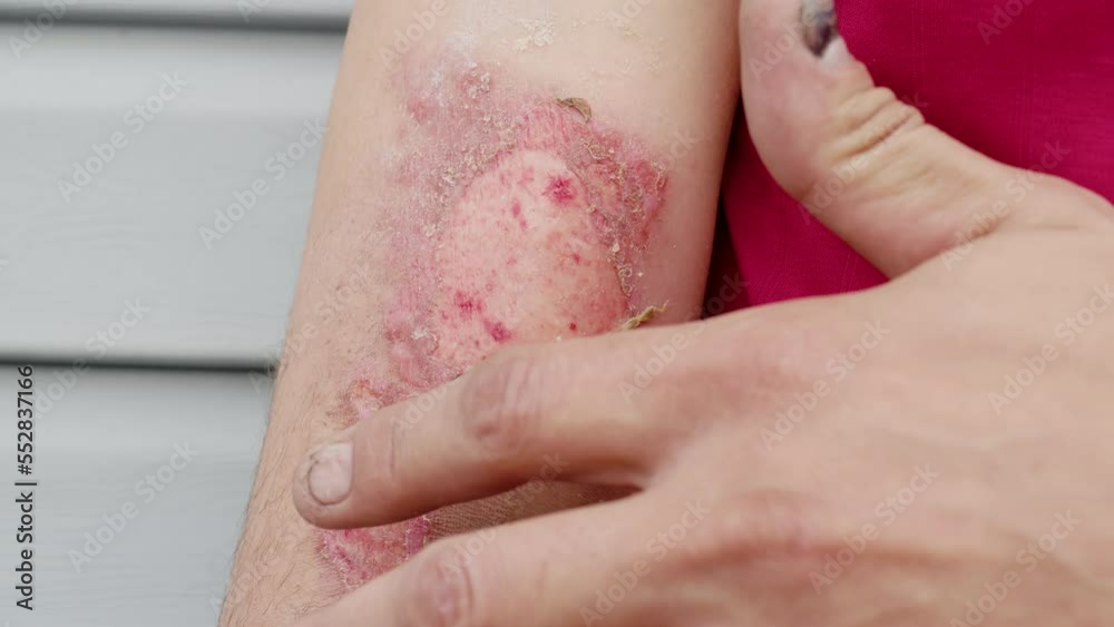 Wound on male arm with peeled skin after fall or burn. Faceless man ...