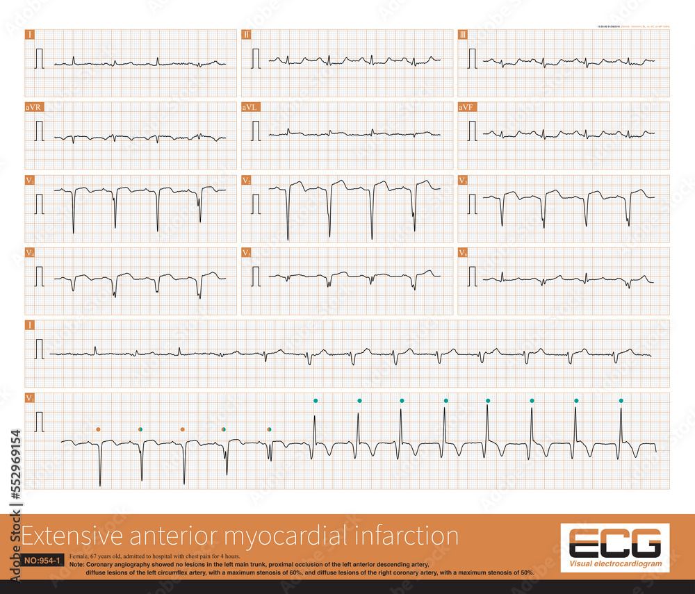 The culprit vessel of extensive anterior wall ventricular infarction is ...