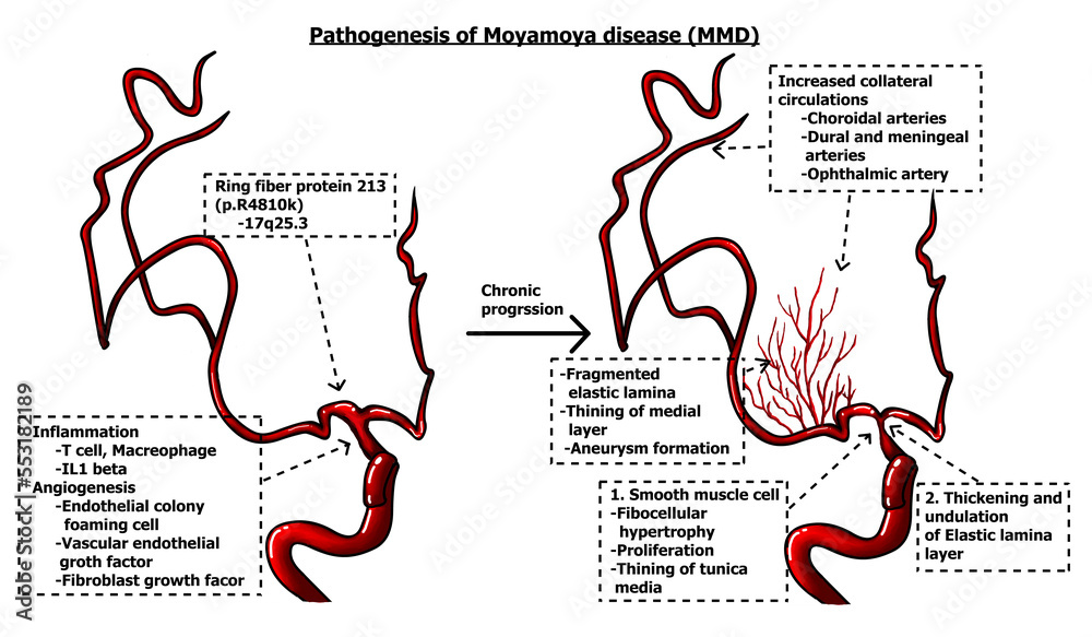 The illustration shown the pathogenesis of Moyamoya disease with ...