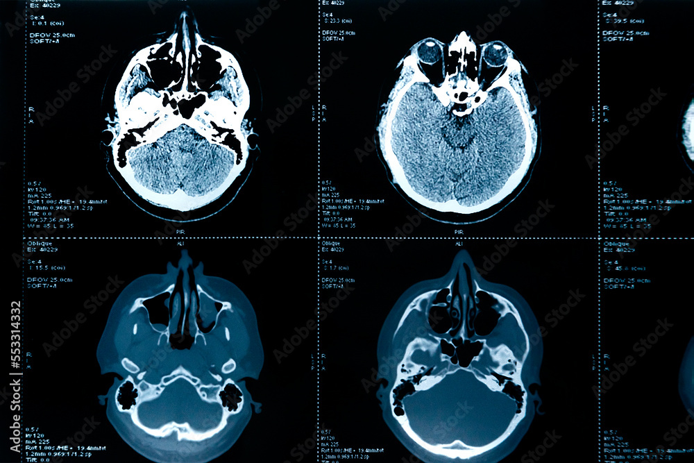 Professional medical MRI X-ray or CT picture scan of male brain,human ...