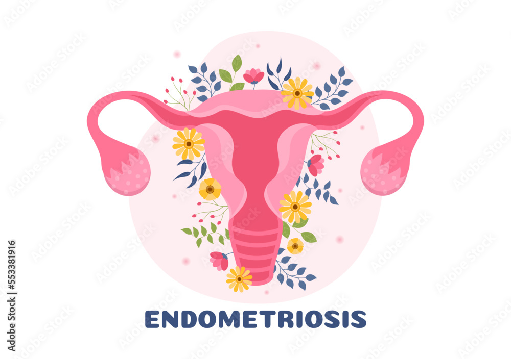 Endometriosis with Condition the Endometrium Grows Outside the Uterine ...