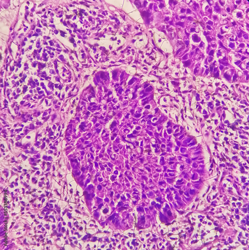 Photomicrograph showing tongue squamous cell carcinoma Grade II. Oral Invasive SCC. Stock Photo ...