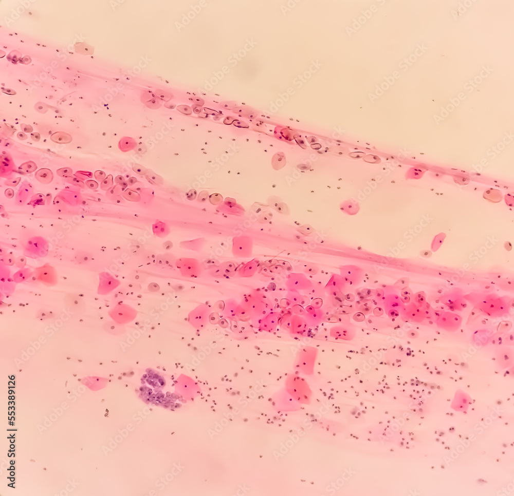 Paps smear under microscopy showing inflammatory smear with hpv related ...