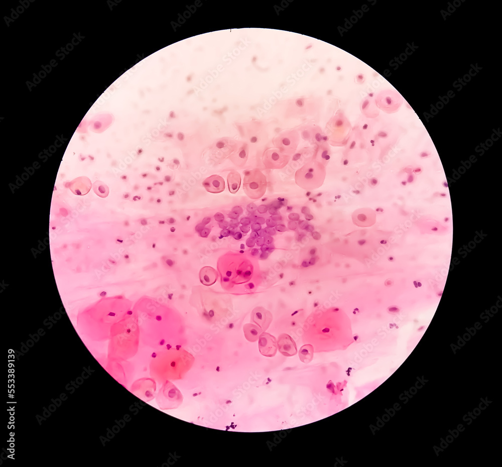 Paps smear under microscopy showing inflammatory smear with hpv related ...