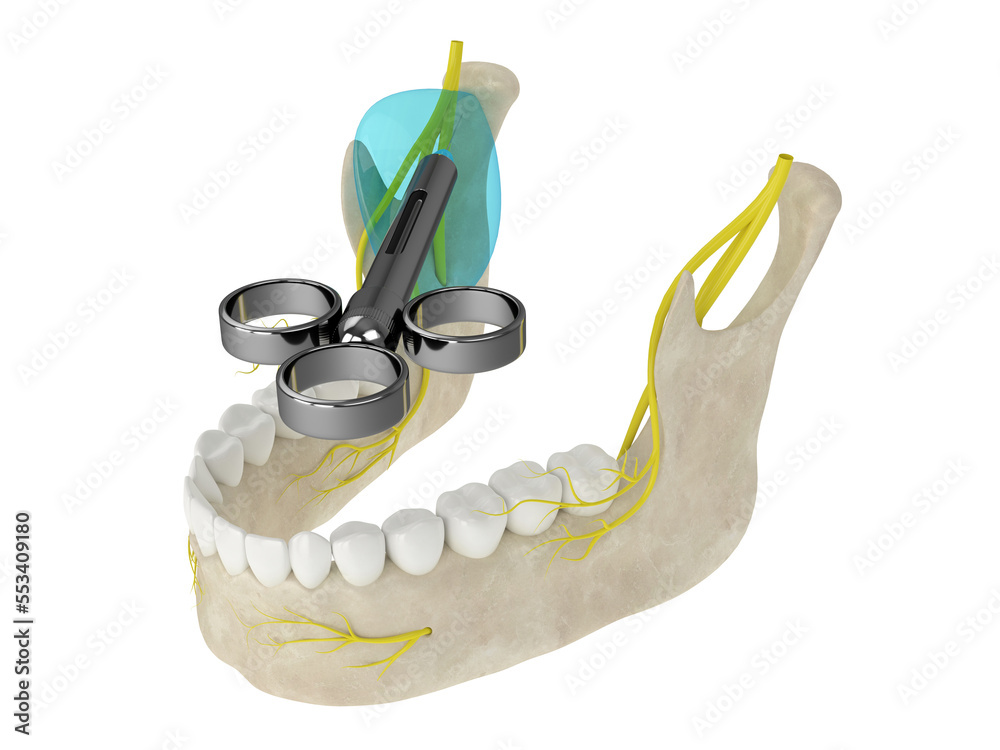 3d render of mandibular arch with gow-gates nerve block Stock ...