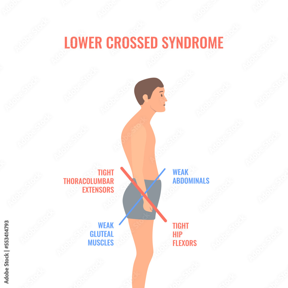Lower crossed syndrome medical diagram. Crooked man with muscle ...