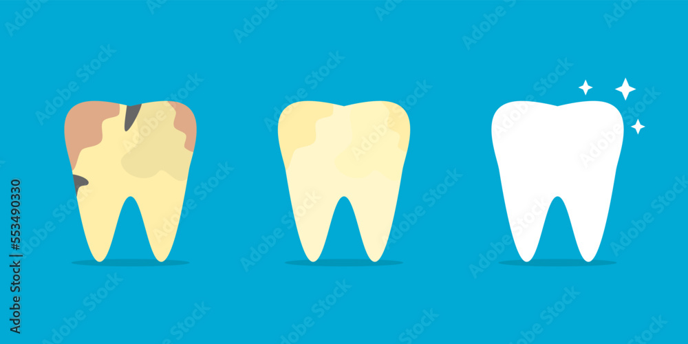 Set before after different tooth decay stains to white shiny clean ...