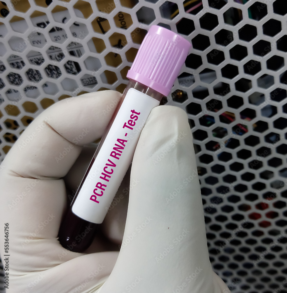 Blood sample for PCR HCV RNA test. Medical or Healthcare concept ...