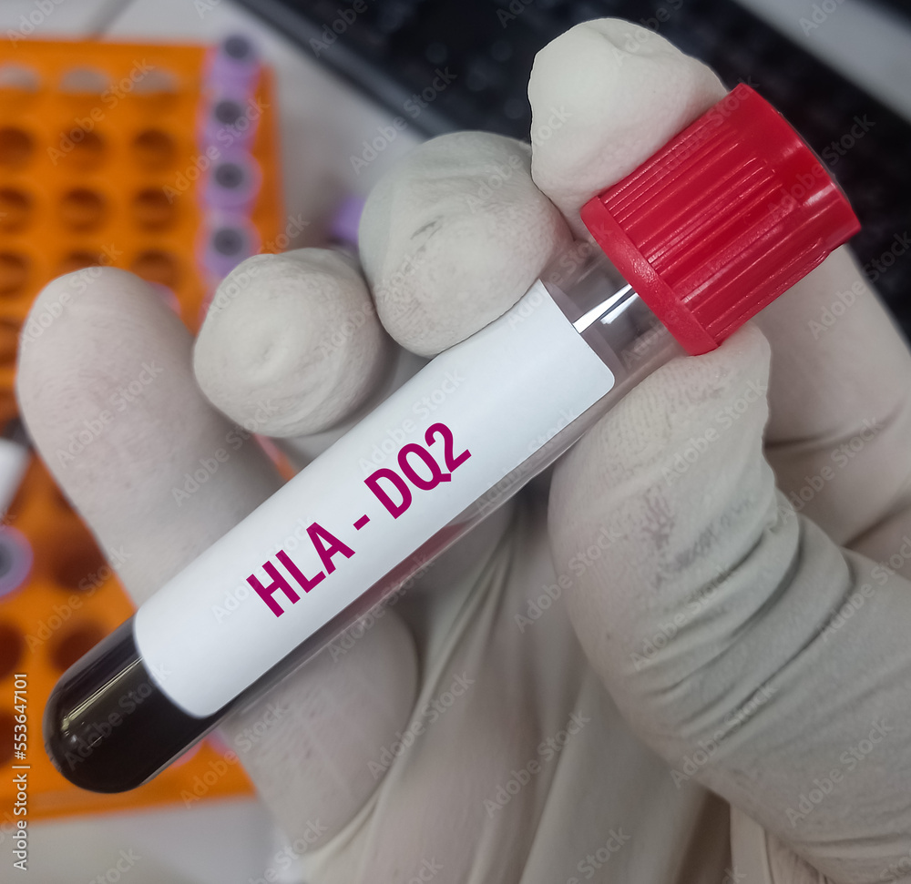 Blood sample for HLA-DQ2 test, diagnosis of celiac disease, human ...