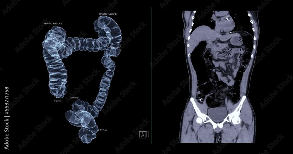 CT colonography 3D rendering with Abdomen coronal view showing intra ...