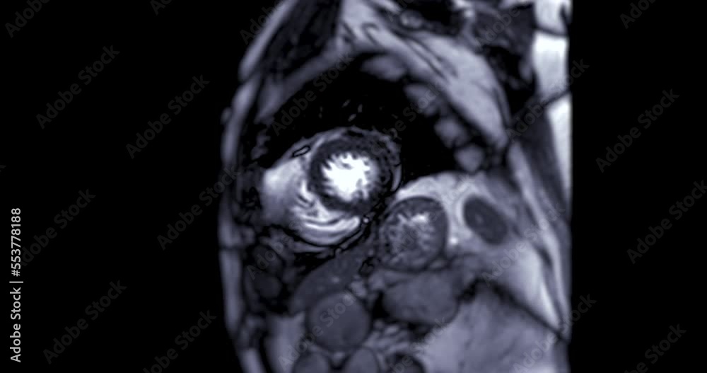 MRI heart or Cardiac MRI ( magnetic resonance imaging ) of heart in ...