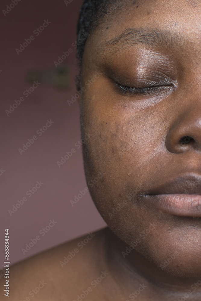 Brown skin with dark spots, hyperpigmentation on brown skin, african ...