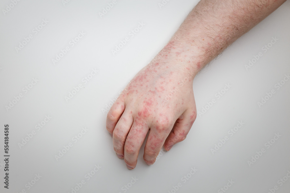 Patient shows arm and hand with red itchy painful rash. Allergic ...