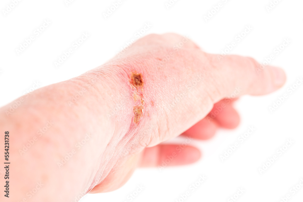 Sodium Hydroxide Burn