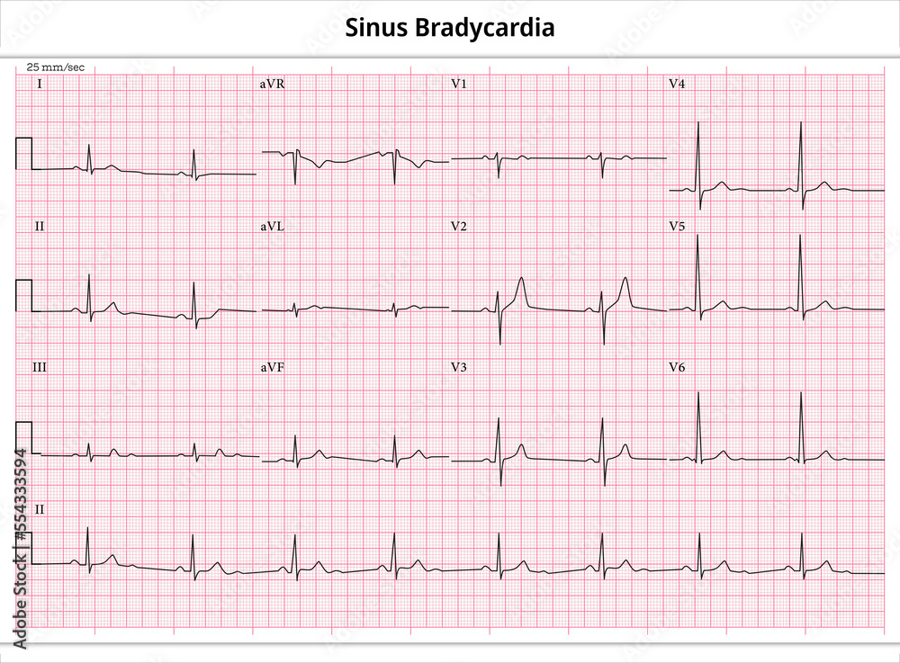 ECG Sinus Bradycardia - ECG Athlete - 12 Leads ECG Paper Stock Photo ...