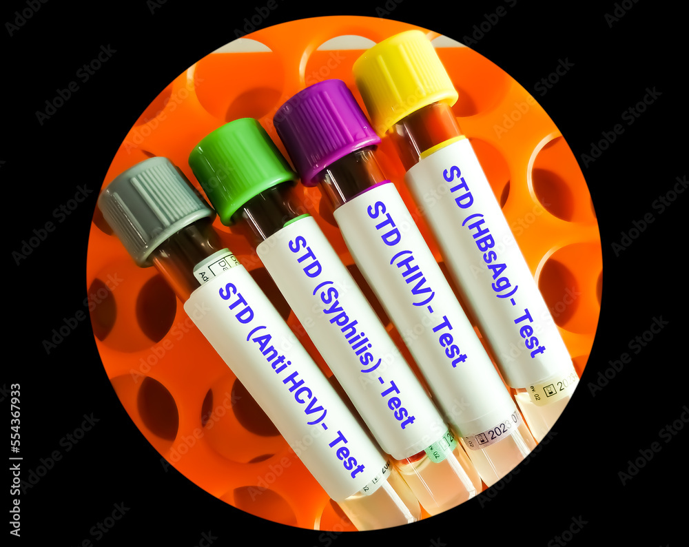 Close view of scientist hand hold blood samples for sexually ...