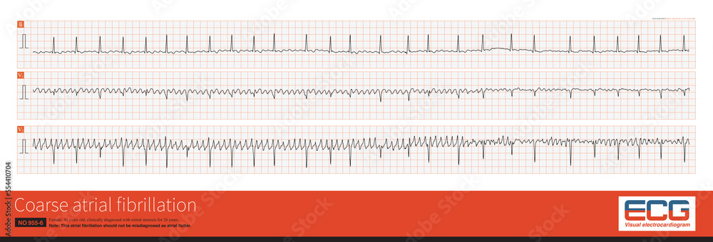 Sometimes, coarse atrial fibrillation is easily misdiagnosed as atrial ...