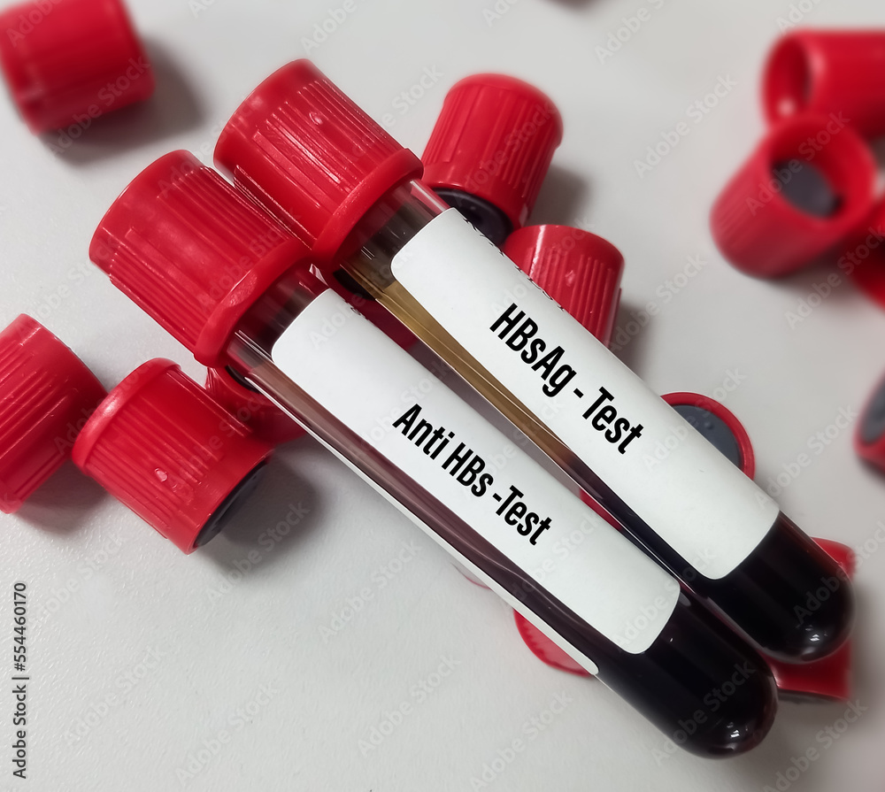 Foto de Blood samples for Anti-HBs and HBsAg test. Hepatitis B Antigen ...