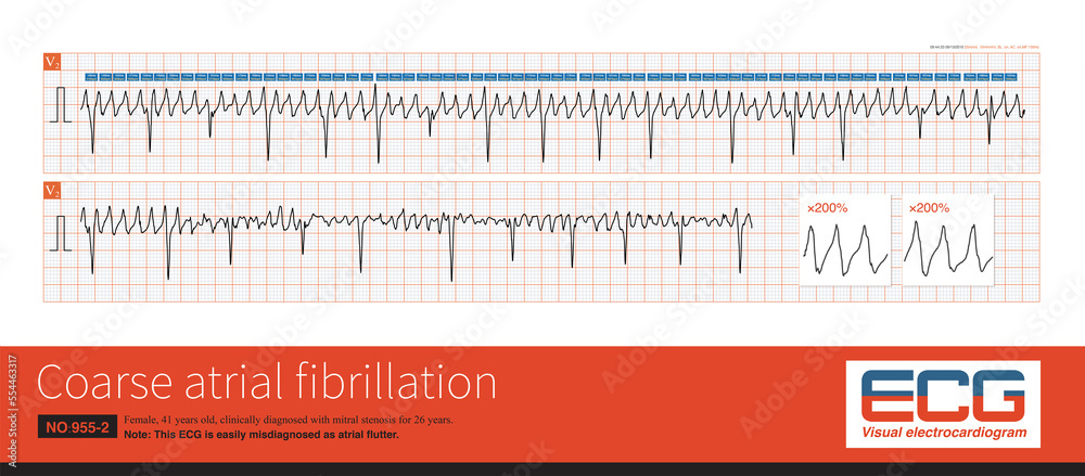 Sometimes, coarse atrial fibrillation is easily misdiagnosed as atrial ...
