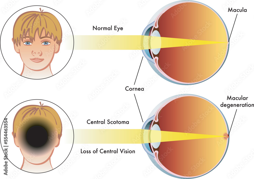 Medical illustration compare a human eye with central scotoma, with normal eye. Stock Vector ...