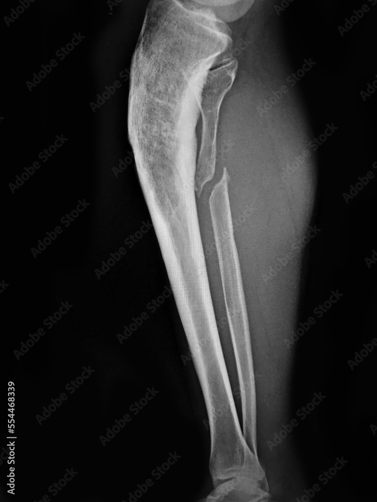 X-ray human fibula fracture Lateral view Stock Photo | Adobe Stock