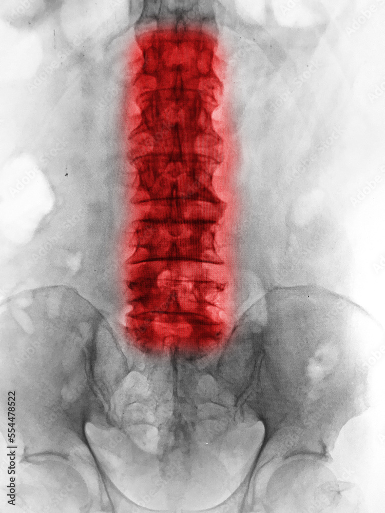X-ray abdomen supine position image Stock Photo | Adobe Stock