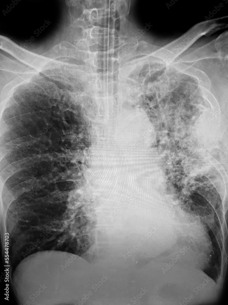 "Pulmonary tuberculosis" Film chest x-ray show interstitial ...