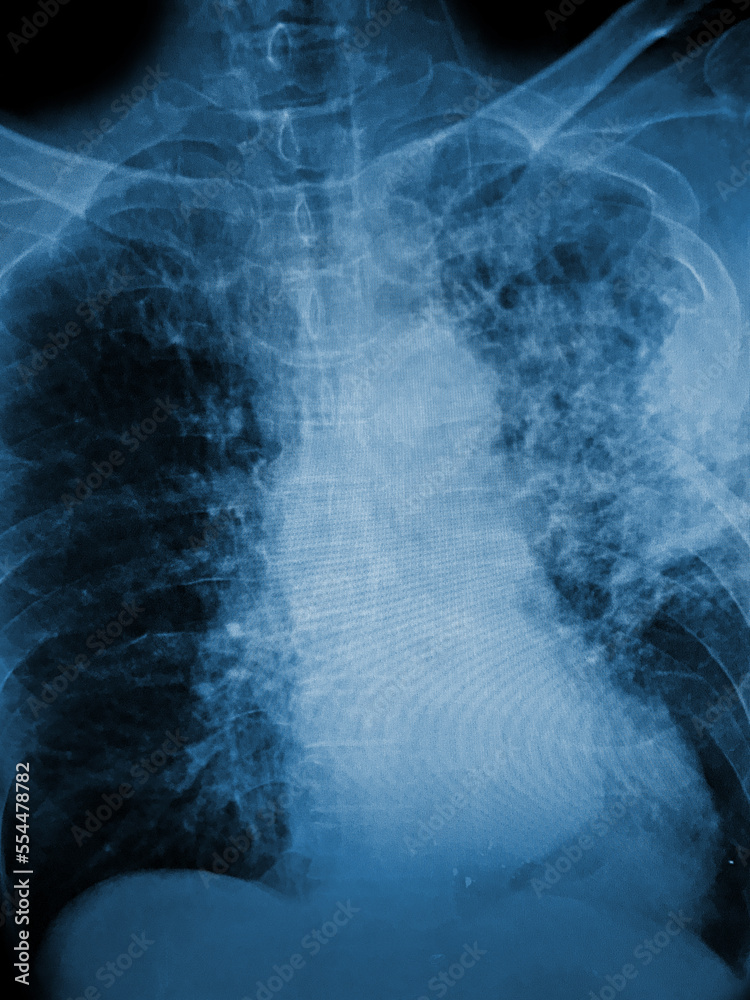 "Pulmonary tuberculosis" Film chest x-ray show interstitial ...
