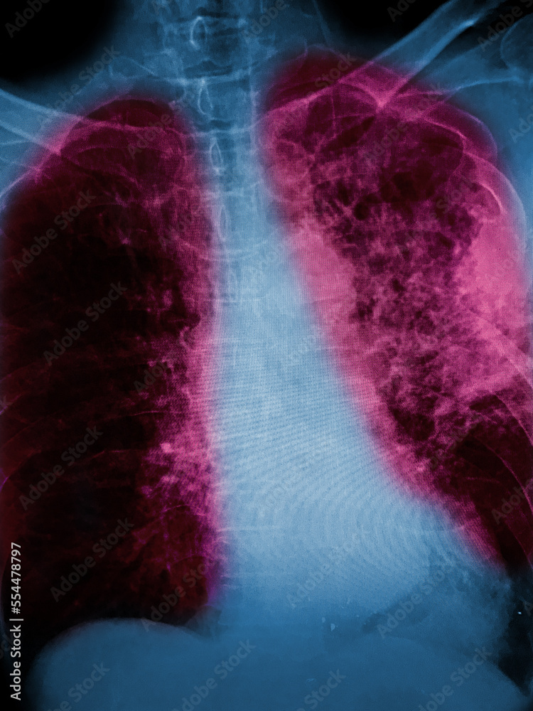 "Pulmonary tuberculosis" Film chest x-ray show interstitial ...