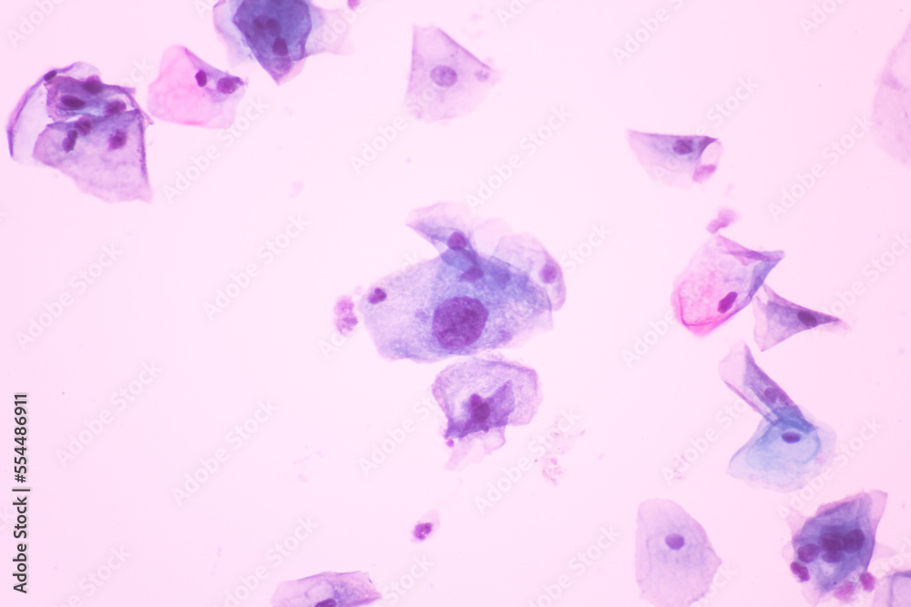 iew in microscopic of Abnormal human cervix cells.Squamous epithelium ...