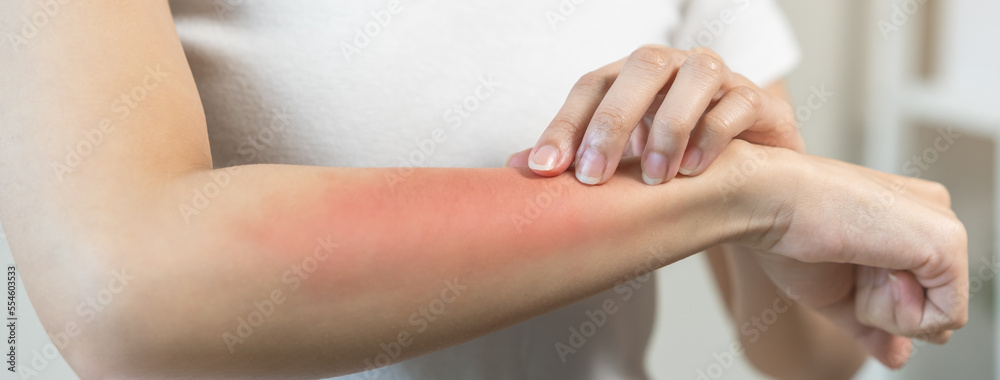 Dermatology asian young woman, girl allergy, allergic reaction from ...