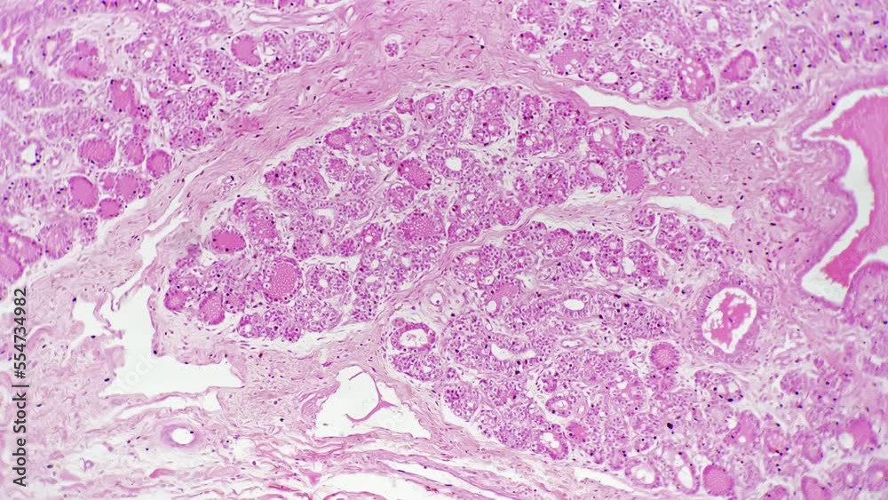 Stasis of mammary gland shown under microscope with 200 times ...